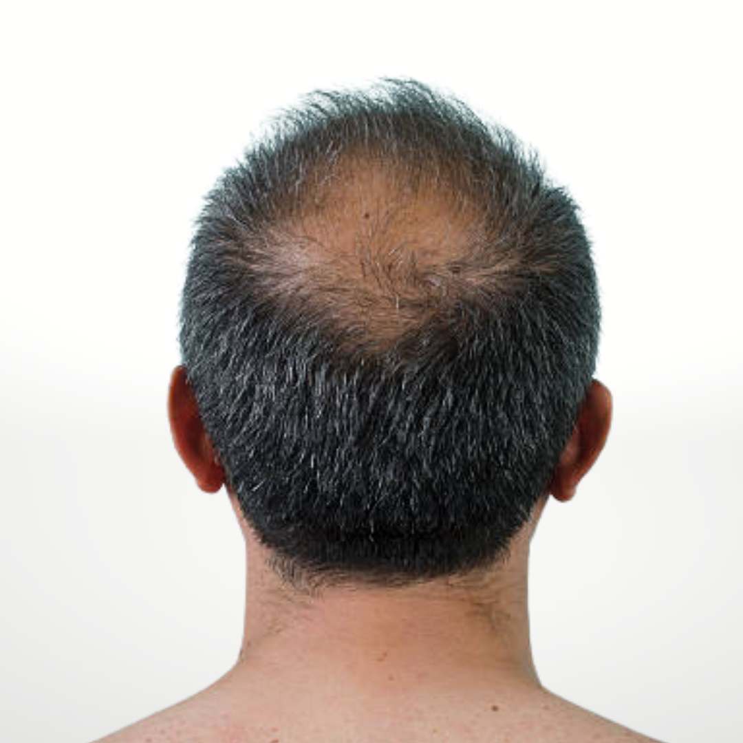 Advanced Hair Treatment in Bhubaneswar | Stella Hair and Skin